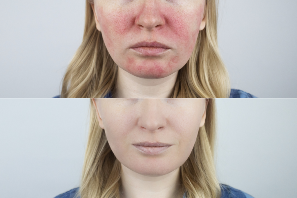 How to manage and treat rosacea - Eleni London